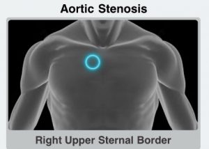 Diagnosis of Aortic Stenosis | Health For Hearts New Zealand